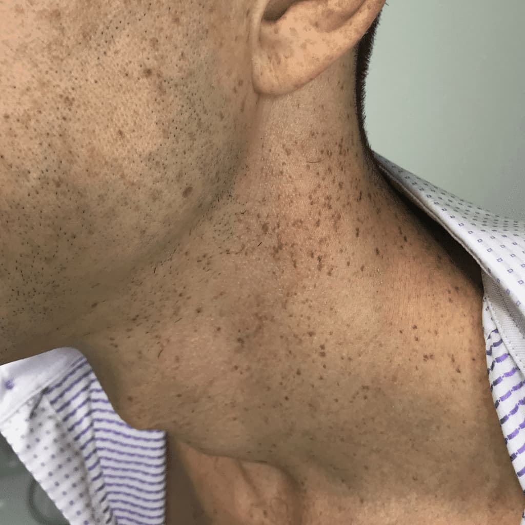 Freckle Laser Removal Sydney | Only 1-2 Treatments Required