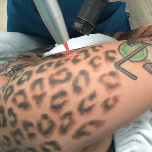 Tattoo Removal Packages | City Laser Clinic Sydney
