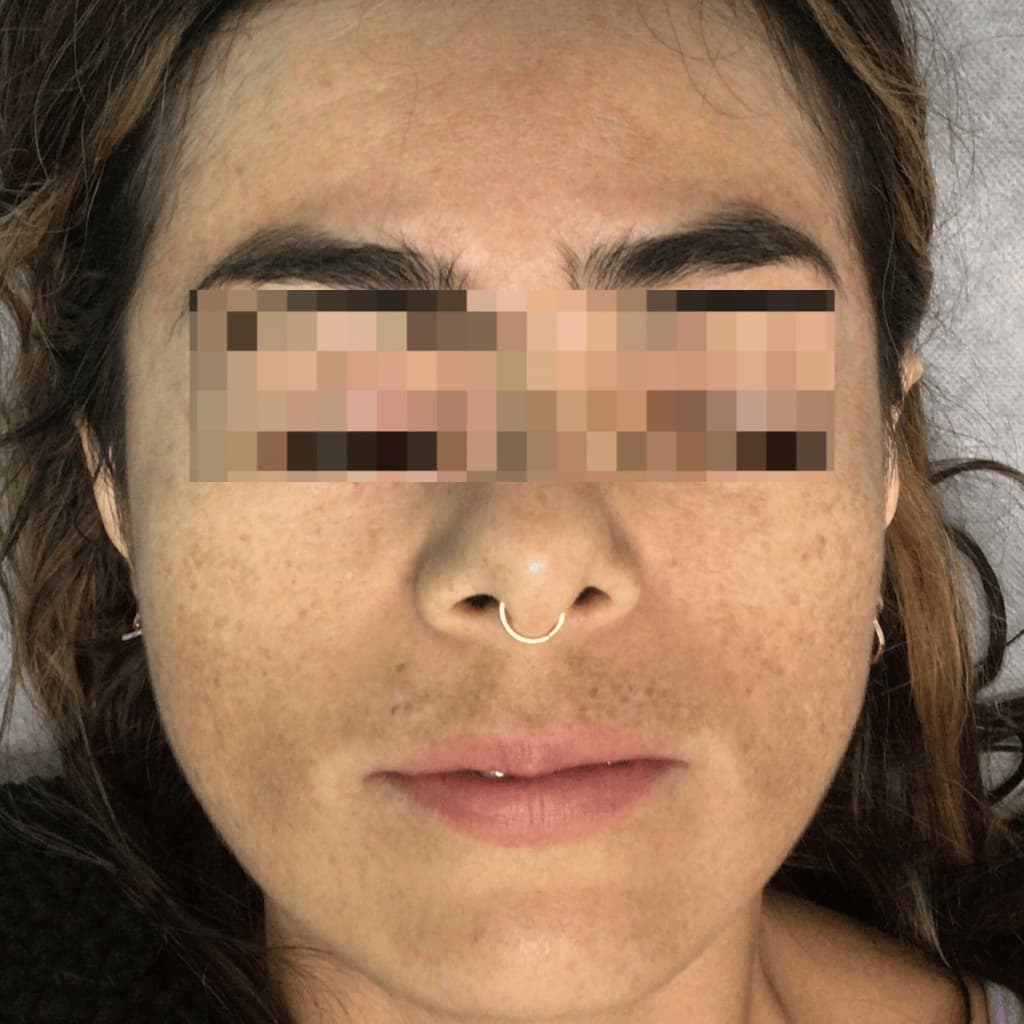 Sun Damage Removal | City Laser Clinic Sydney